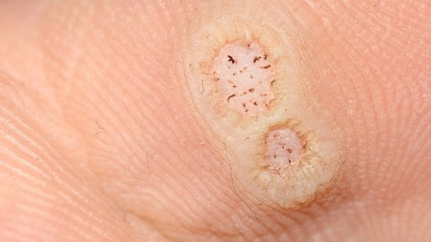 Verruche: eliminarle con la laserterapia - Pozzi Marialuisa